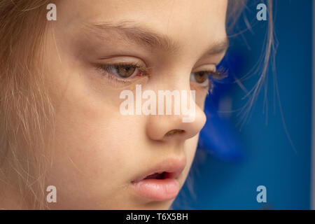 Eye of a child with conjunctivitis, inflammation of the conjunctiva ...