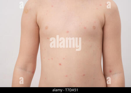 CHICKEN POX LESIONS Stock Photo - Alamy