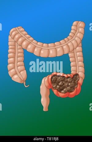 Constipated Colon, Illustration Stock Photo - Alamy