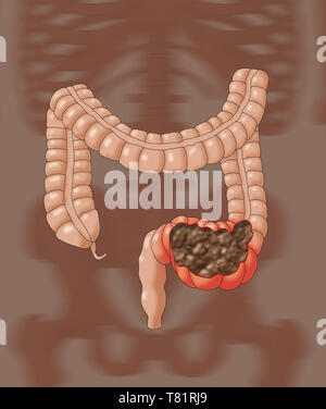 Constipated Colon, Illustration Stock Photo - Alamy