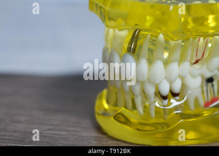 Teeth decay dentistry model showing caries in tooth Stock Photo - Alamy
