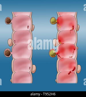 Illustration comparing a colon with diverticulosis (left) and ...