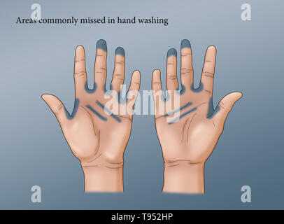 Illustration showing commonly missed areas in hand washing Stock Photo ...