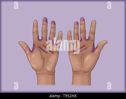 Illustration showing commonly missed areas in hand washing Stock Photo ...