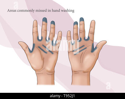 Illustration showing commonly missed areas in hand washing Stock Photo ...