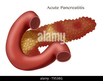An illustration showing a pancreas with acute pancreatitis beneath a ...