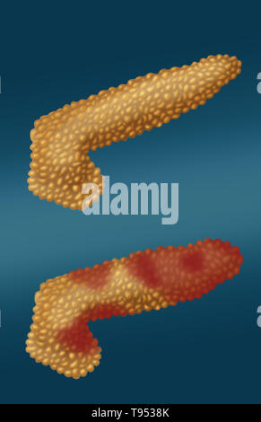 An illustration showing a pancreas with acute pancreatitis ...