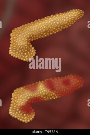 An illustration showing a pancreas with acute pancreatitis beneath a ...