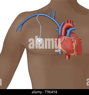 VENOUS ACCESS PORT Stock Photo - Alamy