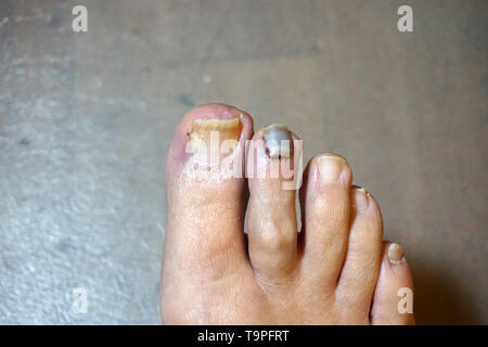 Broken toe and smashed toenail Stock Photo - Alamy