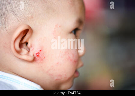 Skin rashes on a baby caused by syphilis; Syphilide Infantile Stock ...