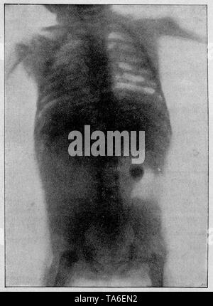 Chest X-ray of a child of 5 who had swallowed a coin. The coin is ...