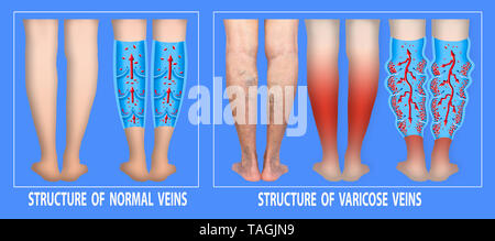 The structure of normal and varicose veins Stock Photo - Alamy