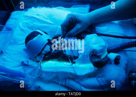 Bathed in blue ultraviolet light, a premature infant is monitored by a ...