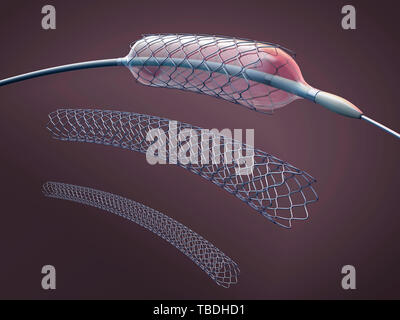 Deflated and inflated stents and balloon catheters, illustration Stock ...