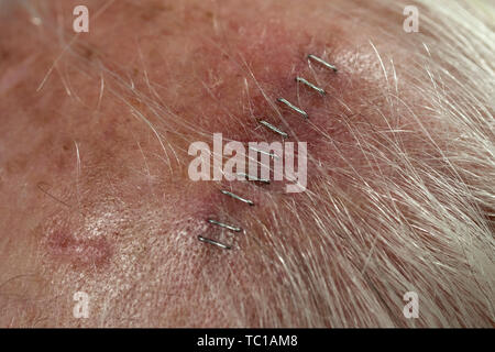 Skin cancer. Close-up of squamous cell carcinoma on the arm of an 81 ...