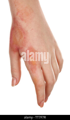 Horrible burns on female hand isolated on white Stock Photo - Alamy