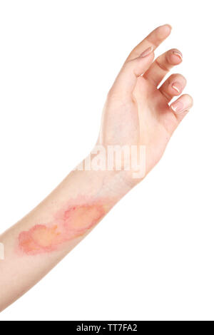 Horrible burns on female hand isolated on white Stock Photo - Alamy