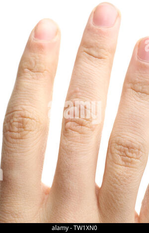 Skin lesion removal procedure. Dermatologist carrying out a removal of ...