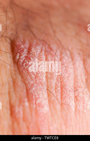 Psoriasis dry red and white irritation on the skin closeup. Image for ...