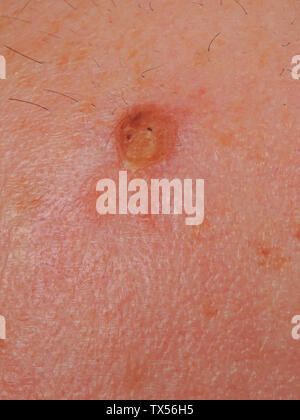 Maladie de bowen du front Stock Photo - Alamy