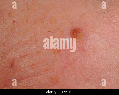 Maladie de bowen du front Stock Photo - Alamy