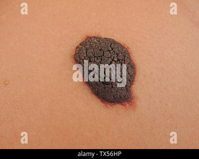 Naevus naevo-cellulaire mixte papillomateux a faible activité ...