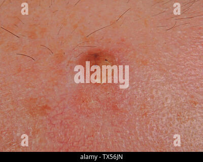 Maladie de bowen du front Stock Photo - Alamy