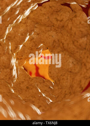 Illustration of fat inside of an artery Stock Photo - Alamy