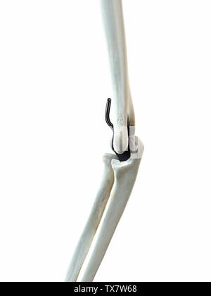 Illustration of an elbow implant Stock Photo - Alamy