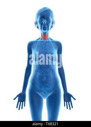 Illustration of an elderly woman with Graves' disease (left) causing an ...