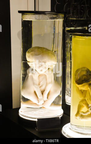 Fetus with malformation in formalin solution in the laboratory museum ...