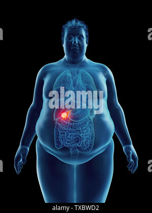 Illustration of an obese man's bladder tumor Stock Photo - Alamy