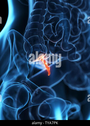 Appendicitis disease or vermiform appendix inflammation 3D rendering ...