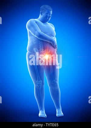 Obese man's painful hip joint, illustration Stock Photo - Alamy