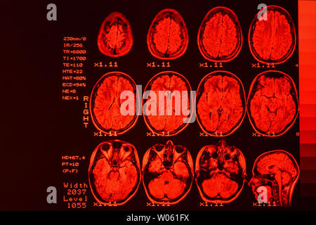 The result is an MRI of the brain with values and numbers. Medical ...