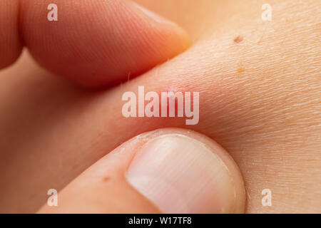 Close up picture of red pimple on human skin Stock Photo - Alamy