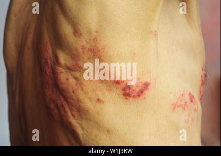 Raised red bumps and blisters caused by shingles on skin Stock Photo ...
