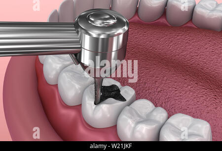 Removing the caries . Medically accurate tooth 3D illustration Stock ...