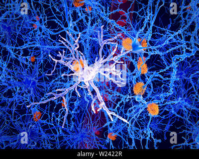 Alzheimer's disease. Illustration of amyloid plaques amongst neurons and neurofibrillary tangles ...