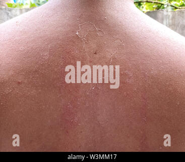 Exfoliation of the skin after sunburn. Excessive tan. The effects of ...