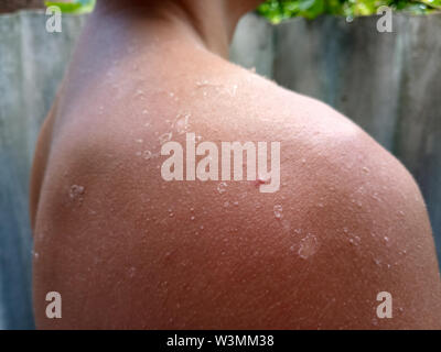 Exfoliation of the skin after sunburn. Excessive tan. The effects of ...