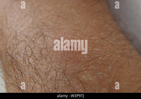 Infected insect bite on the hand of an 48 year old male patient ...