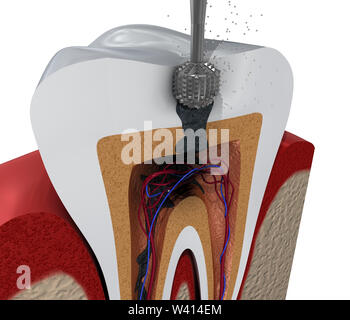 Endodontic root canal treatment process. Medically accurate tooth 3D ...