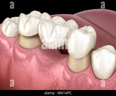 Dental bridge of 3 teeth over molar and premolar. Medically accurate 3D ...