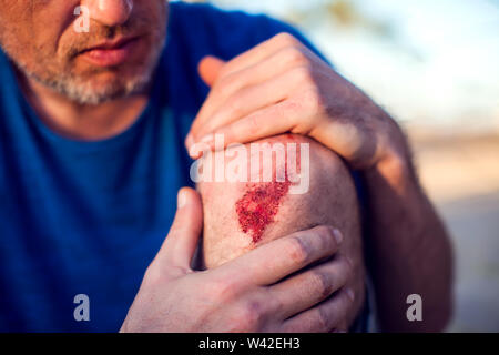 Emergency accident open abrasion wound trauma skin leg knee. People ...