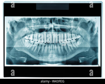 Panoramic x-ray image of teeth. Problem with wisdom tooth Stock Photo ...