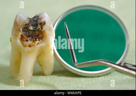 close-up of a human rotten carious tooth at the treatment stage in a ...