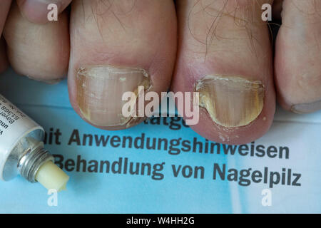 Feet, toenails, with nail fungus infestation, Ointment, anit mushroom ...