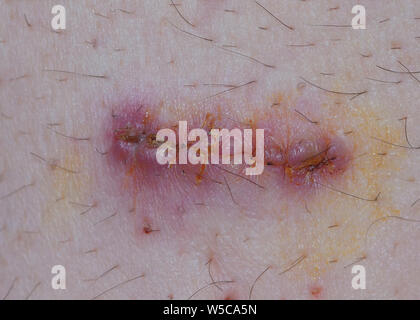 Infected stitched wound (knife cut Stock Photo - Alamy